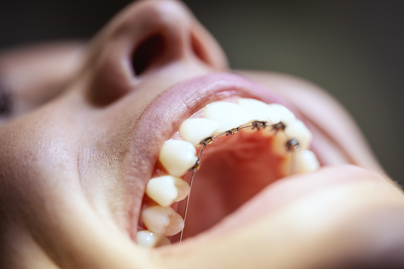 Ortodonti – Uyar Dental Klinik | İskenderun